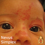 Nevus Simplex Newborn